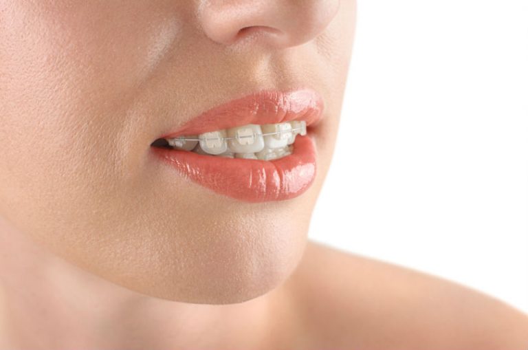 Brackets de zafiro: ¿cuáles son sus ventajas? - AEDN.es